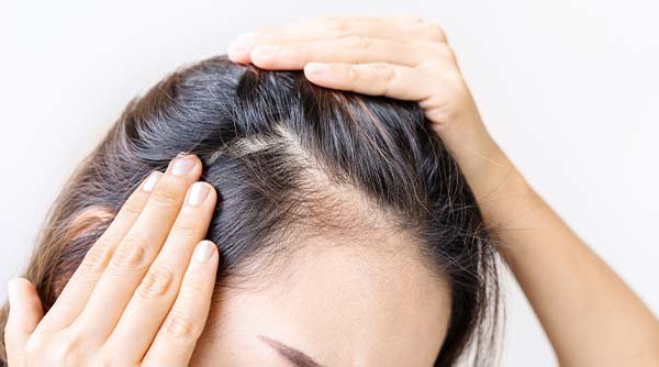 Types of Scalp and How to Protect Them in Summer