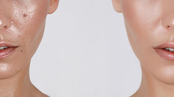 face gets really greasy