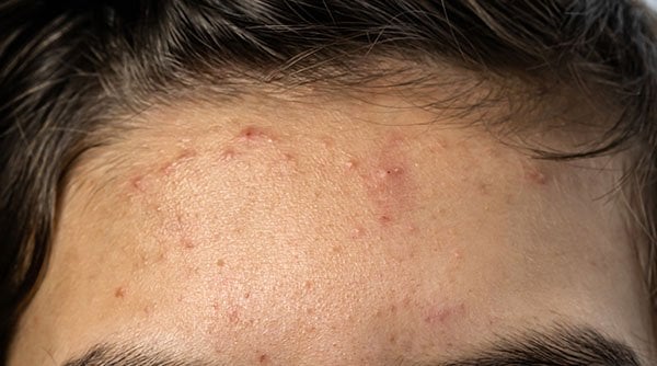 pimples on forehead
