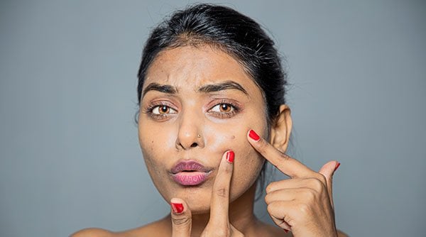 The Best Acids For Acne-Prone Sensitive Skin